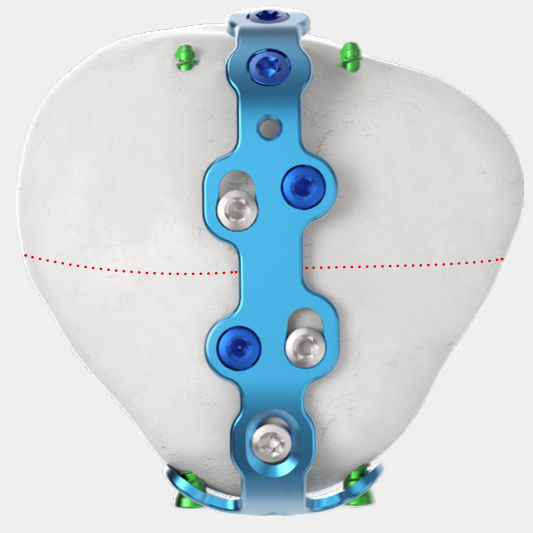 Patella compression plate - Jeil Medical Corporation - locking / titanium