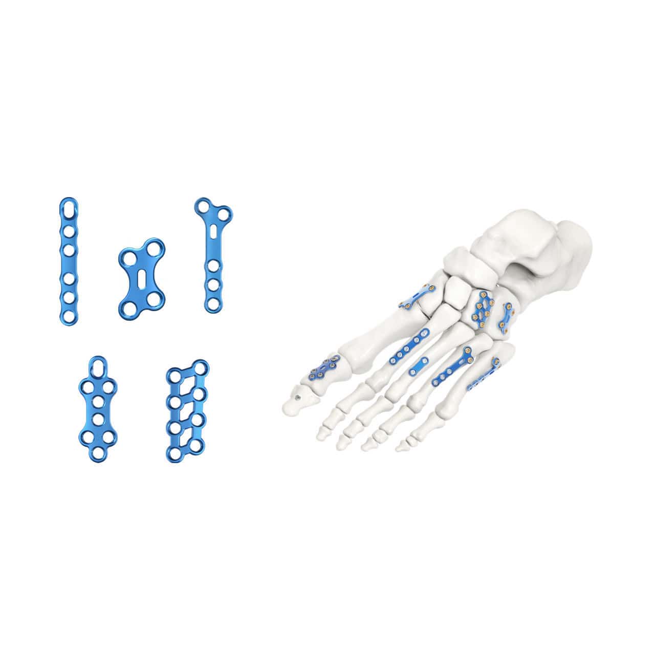 Foot phalange compression plate - Jeil Medical Corporation - forefoot ...