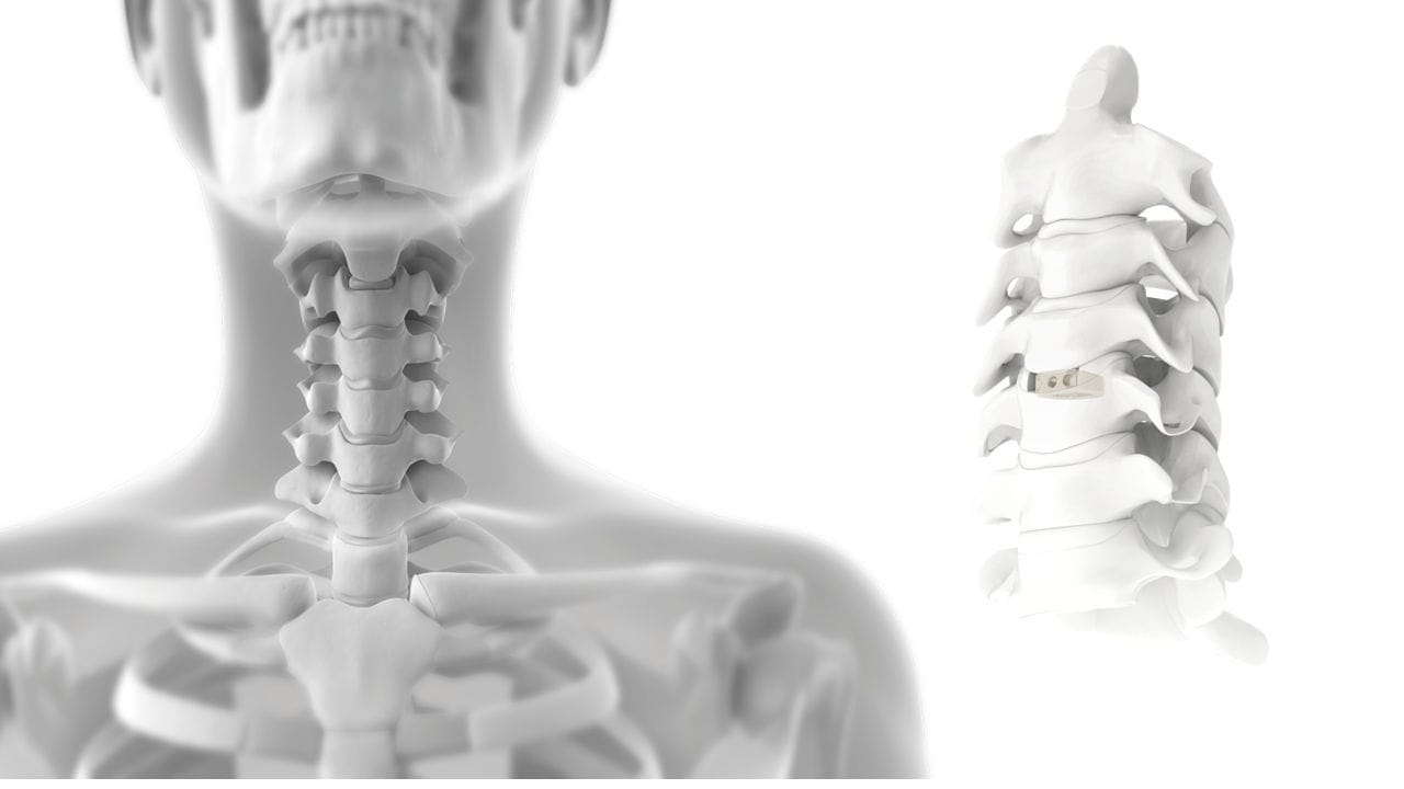 Cervical interbody fusion cage - FIX-C - Jeil Medical Corporation ...