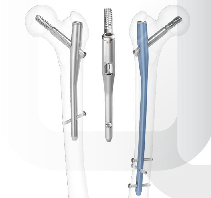 Femoral intramedullary nail - ARIX - Jeil Medical Corporation ...