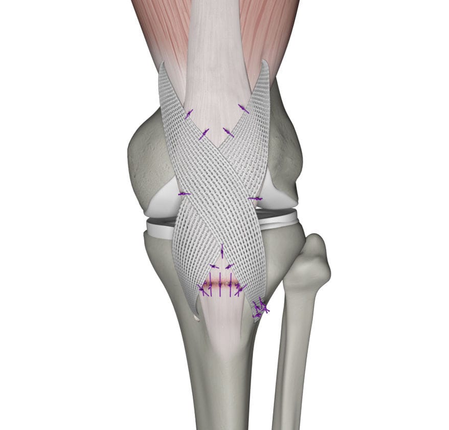 Quadriceps tendon ligament prosthesis - QuadsTape ™ - Neoligaments ...
