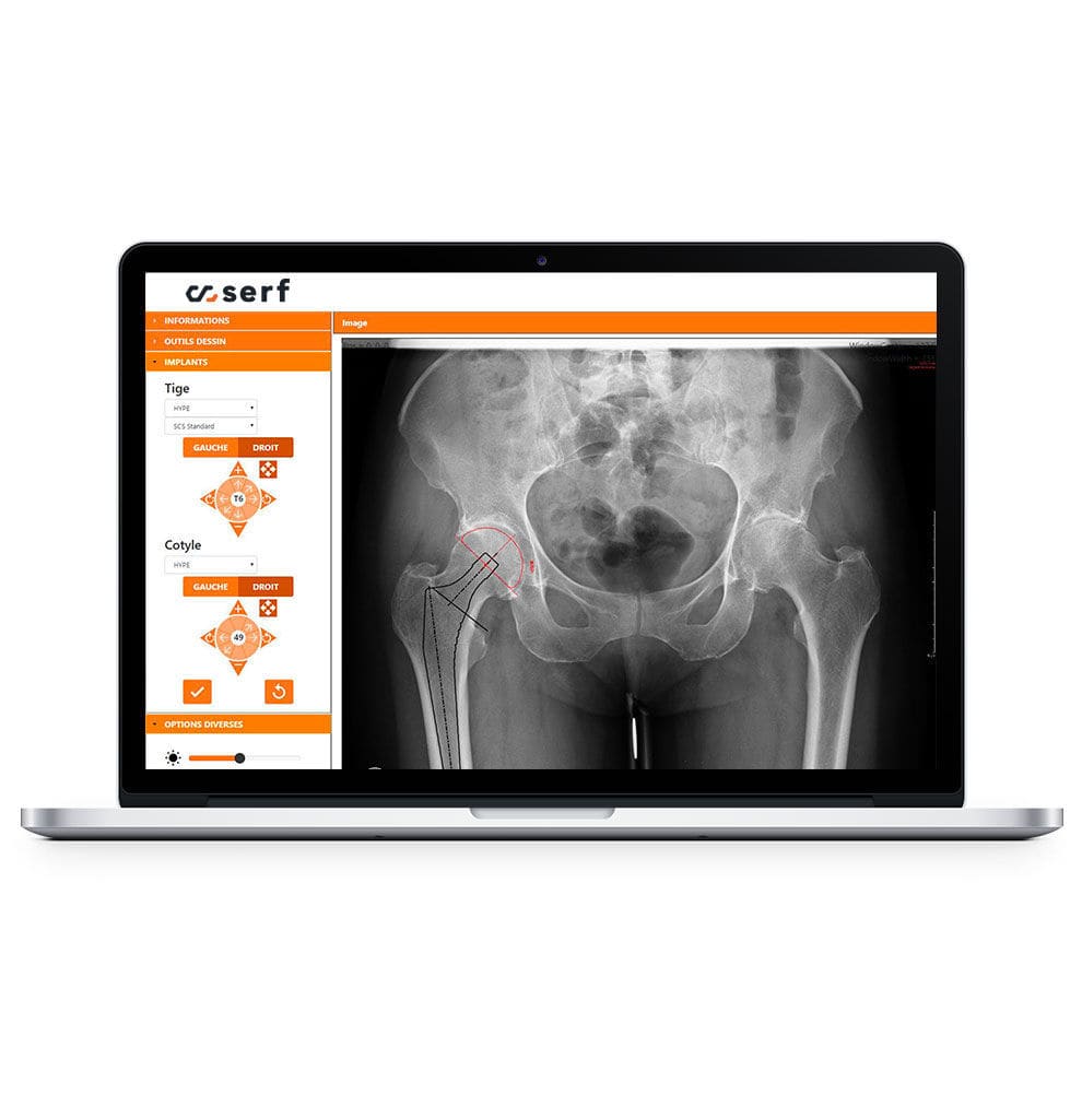 Planning software - SERF - orthopedic / for tablet PC