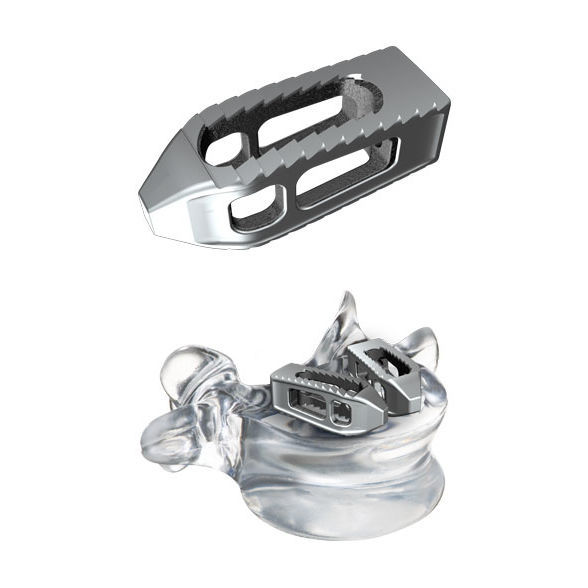 Lumbo-sacral interbody fusion cage - tezo™ - ulrich medical ...