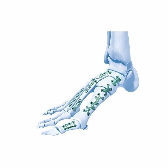 Metatarsal bone compression plate - Double Medical Technology - foot ...