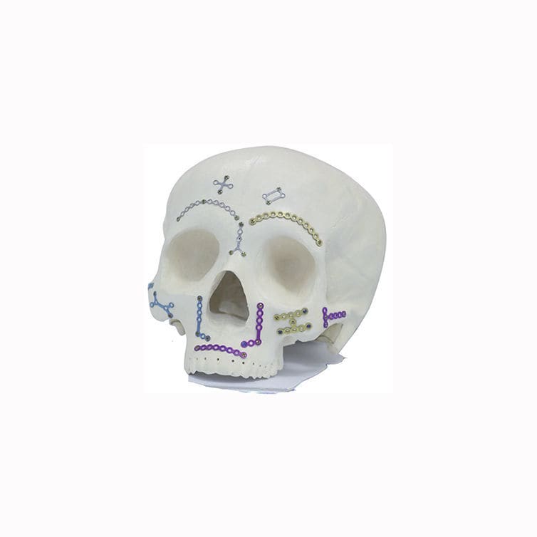 Maxillofacial compression plate - Double Medical Technology - metallic