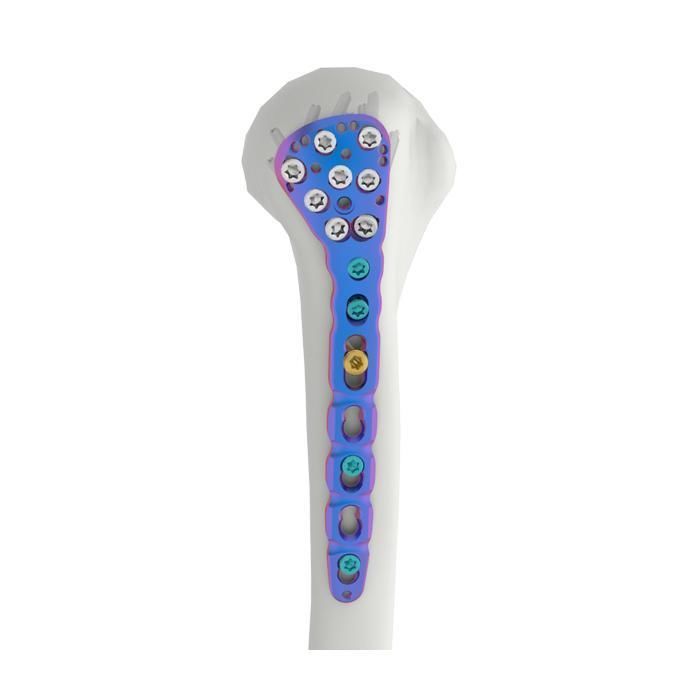 Humeral compression plate - VAL - Double Medical Technology - proximal ...
