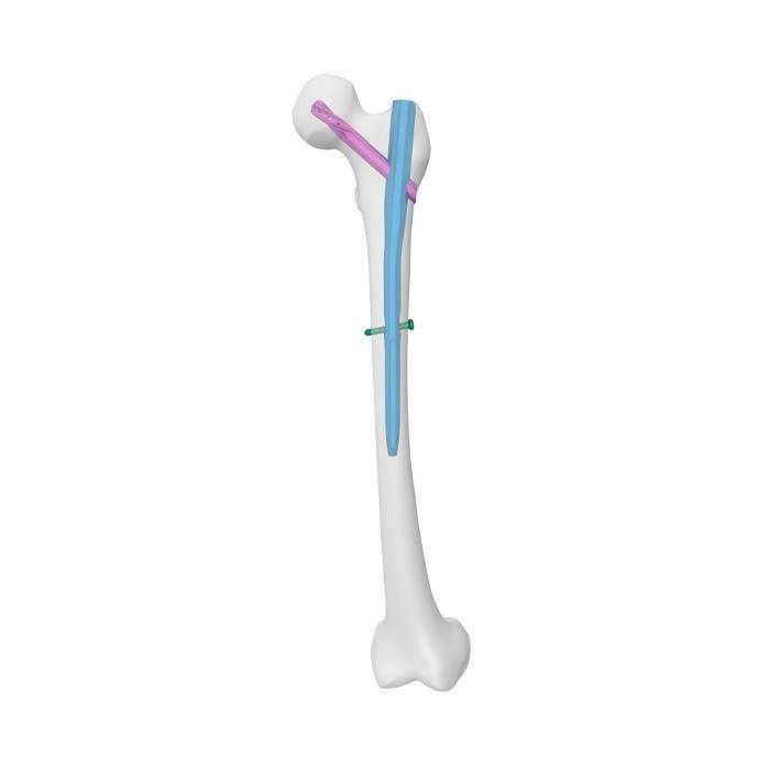 Femoral intramedullary nail - APFN Aimstrong - Double Medical ...
