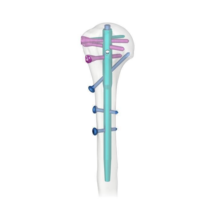 Humeral intramedullary nail - AHN - Double Medical Technology ...