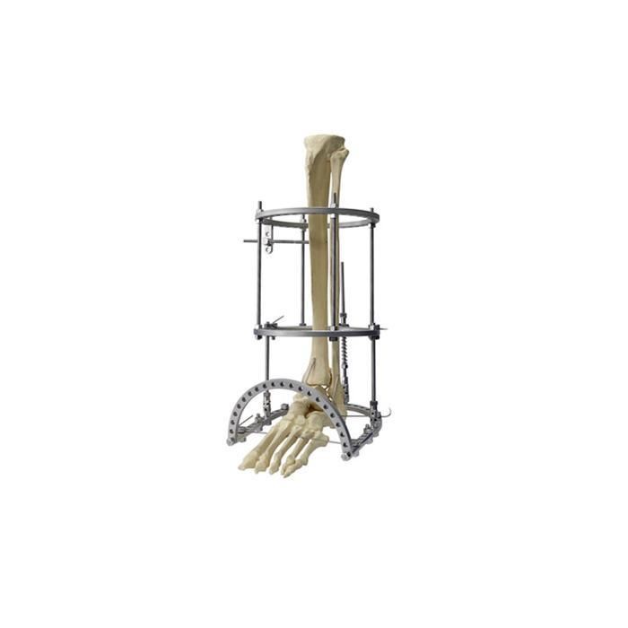 Tibia external fixation system - Double Medical Technology - ankle ...
