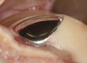 Metatarsophalangeal joint implant - HEMICAP® - Arthrosurface