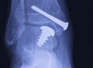 Metatarsophalangeal joint implant - HEMICAP® - Arthrosurface