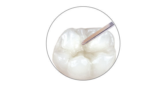 Flowable composite dental material - Ceram.x Spectra ST flow - Dentsply ...