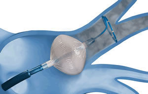Cryoablation catheter / cardiac / balloon / steerable - Arctic Front ...