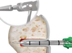 Biceps tendon suture anchor - BICEPTOR - Smith & Nephew - non-absorbable