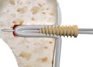 Biceps tendon suture anchor - BICEPTOR - Smith & Nephew - non-absorbable