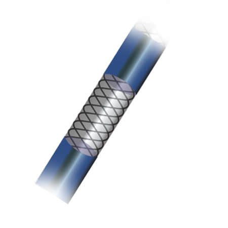 Transseptal access sheath / with hemostatic valve - TorFlex™ - Baylis ...