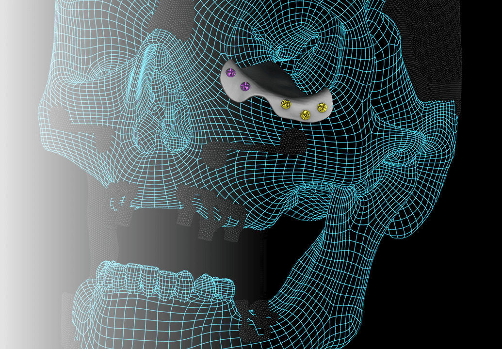 Custom-made periorbital implant - ORBIT - A.B. Dental Devices
