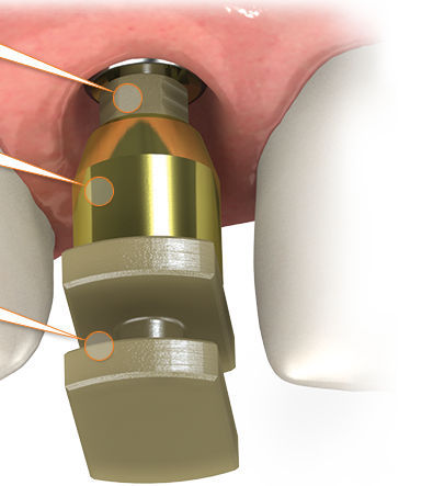 Titanium impression coping - TP3RSC - BioHorizons - Videos