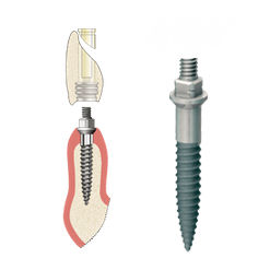 Conical dental implant - ANEW - DENTATUS AB - titanium / external / narrow