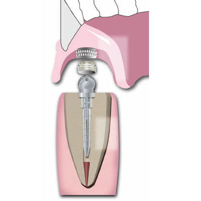 Metal root post - Flexi-Overdenture - ESSENTIAL DENTAL SYSTEMS