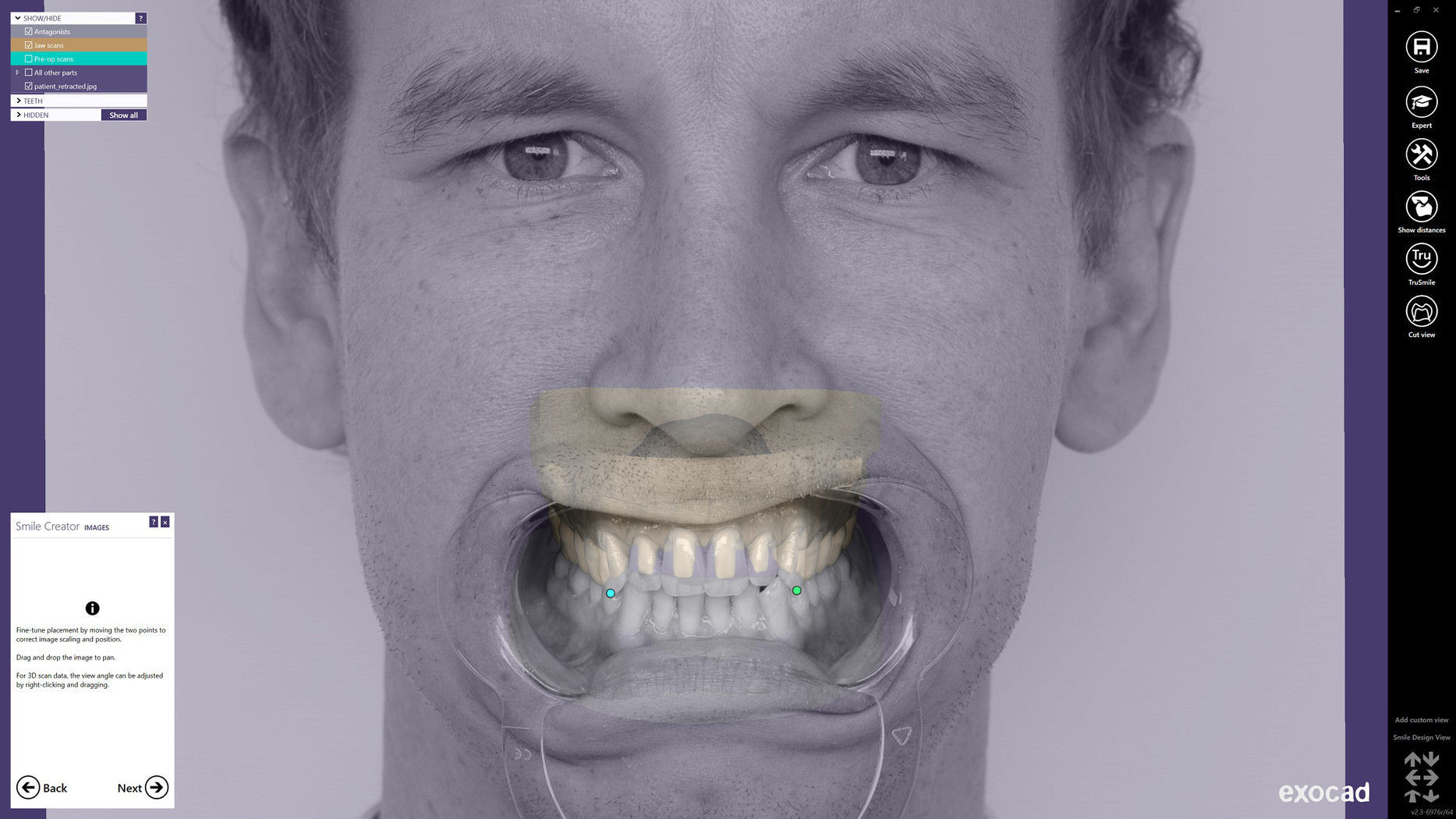 Analysis software - Smile Creator - exocad GmbH - planning / design / CAD