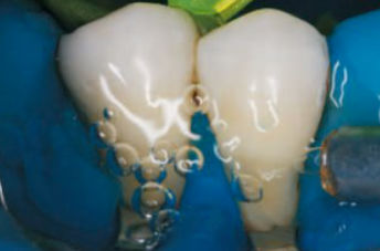 Dental restoration adhesive - Ambar - FGM Dental Products - liquid ...