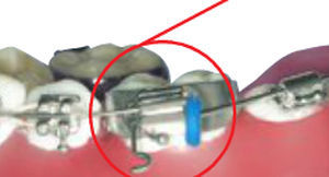 Orthodontic archwire - Molar Correction Spring - FORESTADENT BERNHARD ...