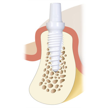 Conical dental implant - Z5m(t) - Z-Systems AG - ceramic / one-piece ...