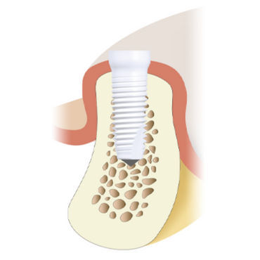 Cylindrical dental implant - Z5-TL - Z-Systems AG - ceramic / internal ...