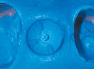 Straight healing abutment / titanium / internal - BellaTek® Encode ...