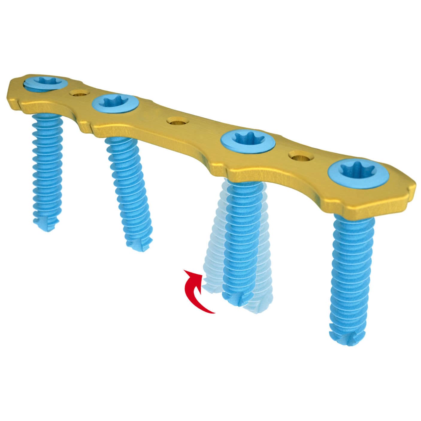 Metacarpal joint compression plate - Micromed Medizintechnik - locking ...