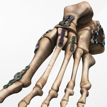 Forefoot compression plate - A.L.P.S.® - Zimmer Biomet - locking / non ...