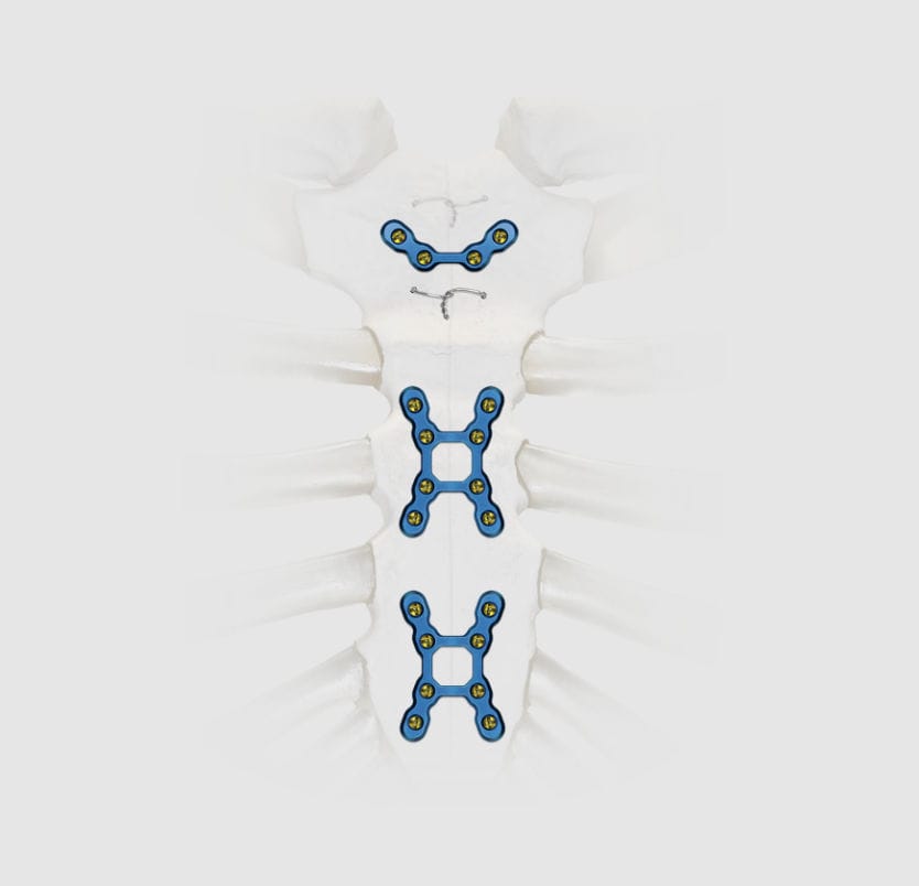Sternum compression plate - SternaLock® Blu - Zimmer Biomet - locking ...
