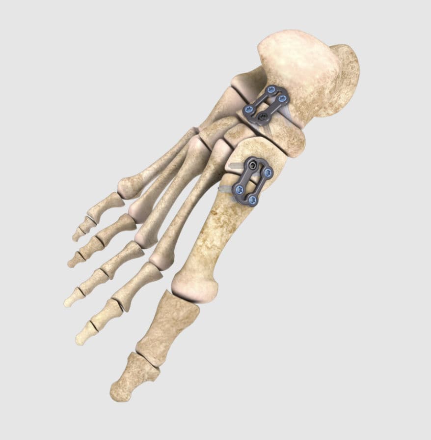 Forefoot compression plate - A.L.P.S.® - Zimmer Biomet - hindfoot ...