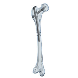 Femur intramedullary nail / tibia / proximal / distal - Zimmer® Natural ...