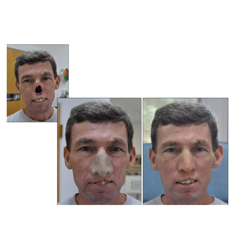 Nasal cosmetic prosthesis - RealLifeSkin™ - RealLifeSkin - adult