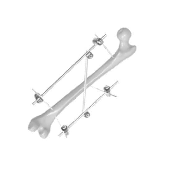 Femur external fixation system - 206307 - SOFEMED International ...