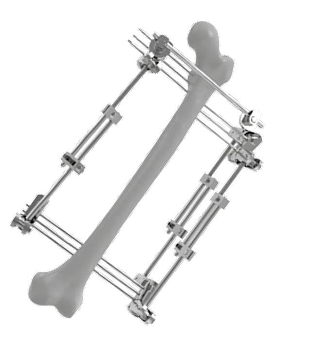 Femur external fixation system - 201501 - SOFEMED International ...