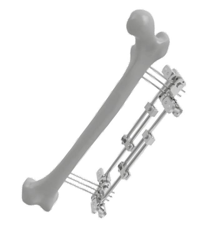 Femur external fixation system - 201502 - SOFEMED International ...