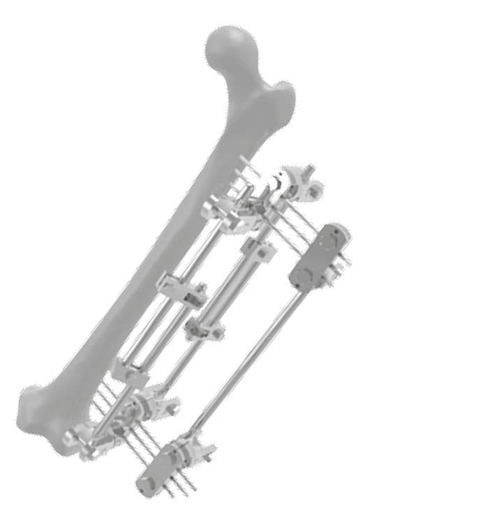 Femur external fixation system - 201503 - SOFEMED International ...
