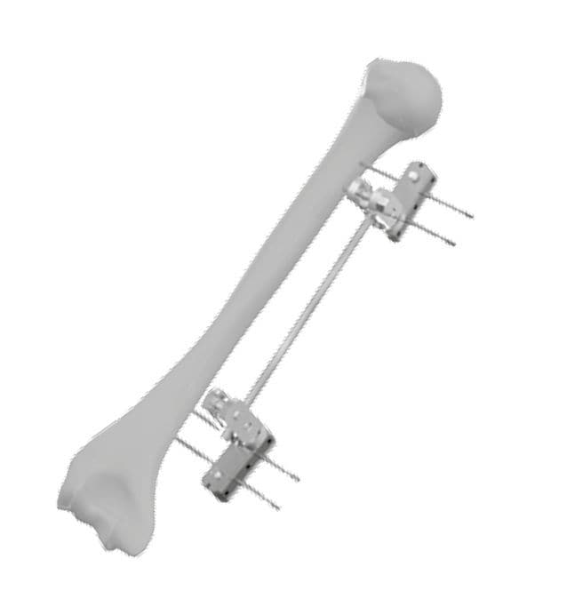 Humerus external fixation system - 201541 - SOFEMED International ...