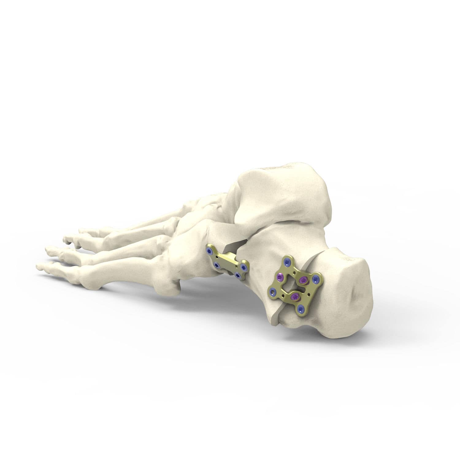 Calcaneus osteotomy plate - FDTSDN1 - Newclip Technics - metallic