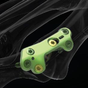 Metatarsophalangeal joint arthrodesis plate - MTP - Newclip Technics ...