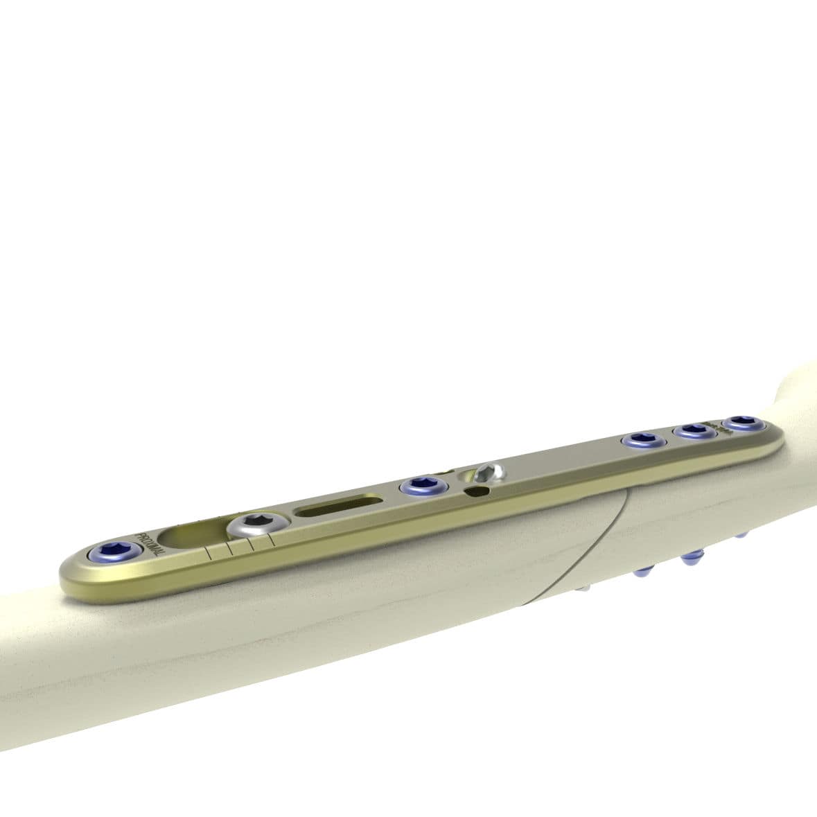 Ulna osteotomy plate - HTSIS2 - Newclip Technics - mid-shaft / locking ...