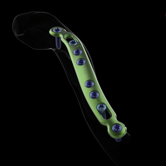 Clavicle compression plate - ALIANS CLAVICLE S - Newclip Technics ...