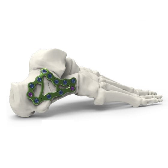 Calcaneus compression plate - Calcanheal - Newclip Technics - locking ...