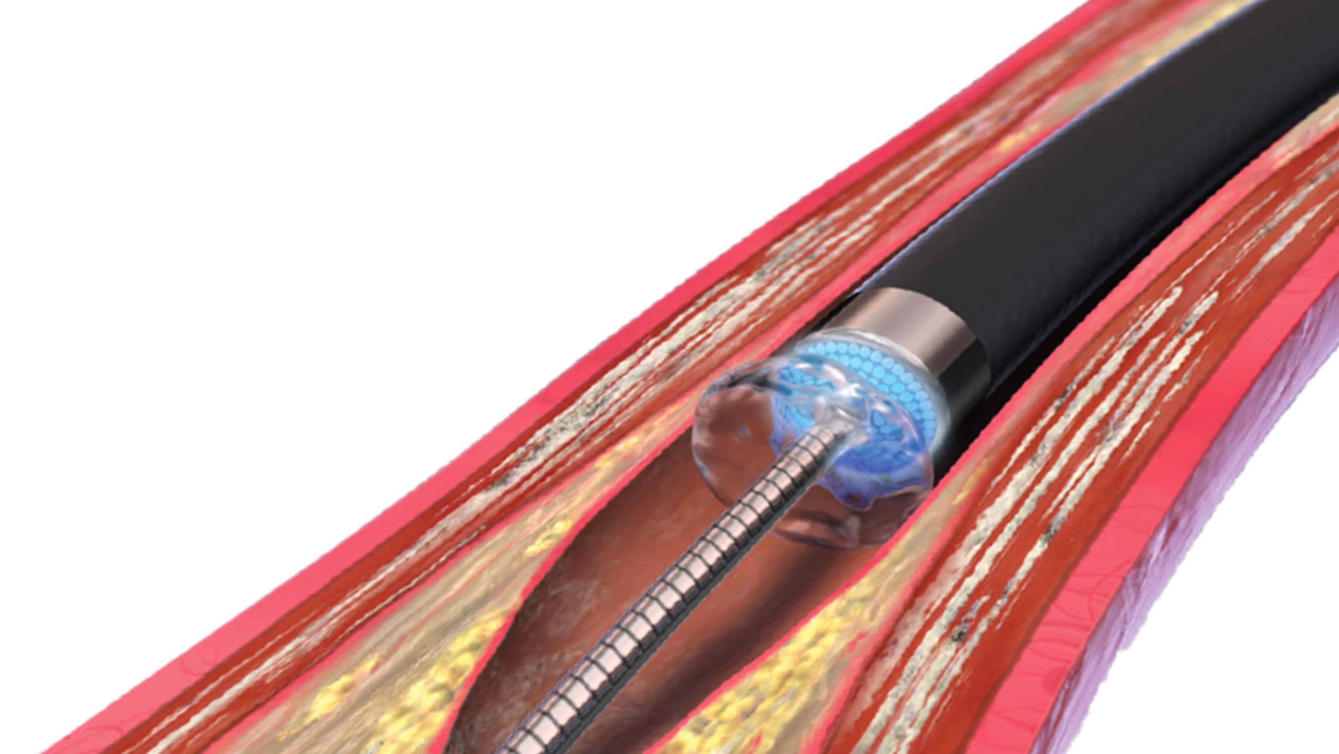 Laser atherectomy catheter / peripheral - Turbo-Elite - Philips Volcano