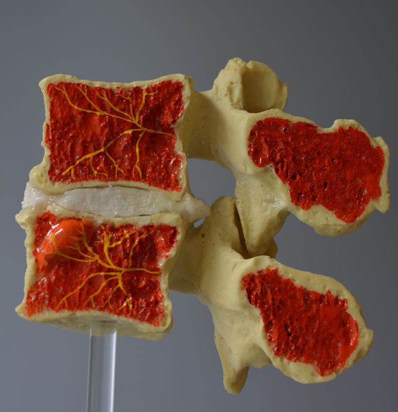 Intervetebral disc model - Modic - Dynamic Disc Designs Corp. - for ...