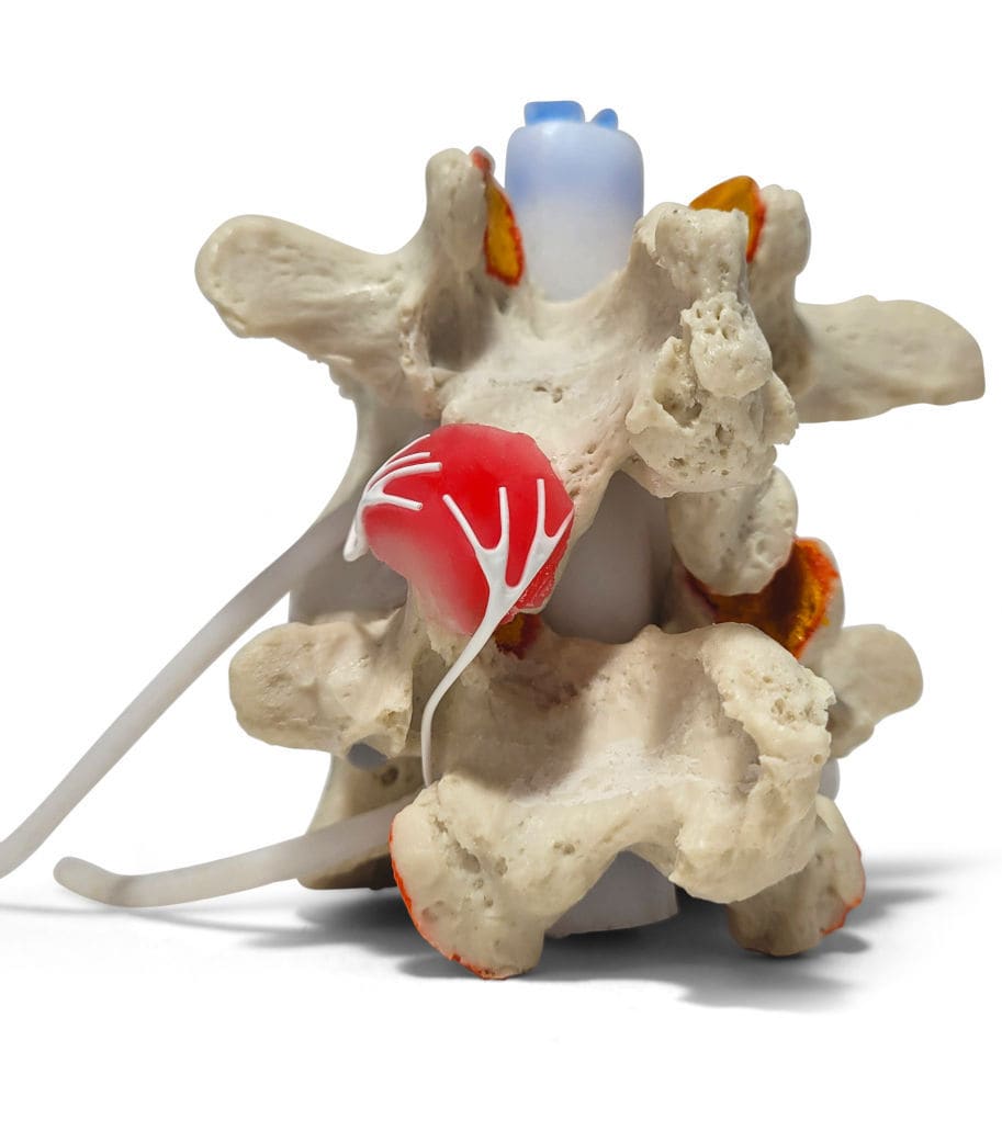 Intervetebral disc model - Degenerative - Dynamic Disc Designs Corp ...