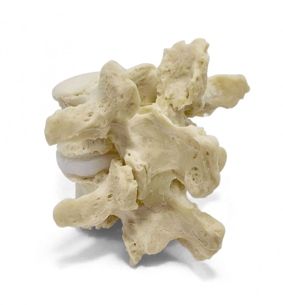 Lumbar spine anatomical model - Dynamic Disc Designs Corp ...